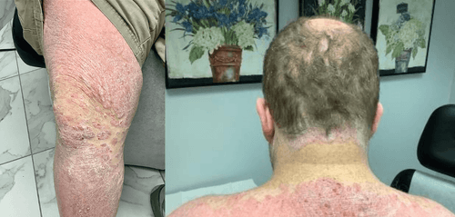 Treating Severe Recalcitrant Psoriasis