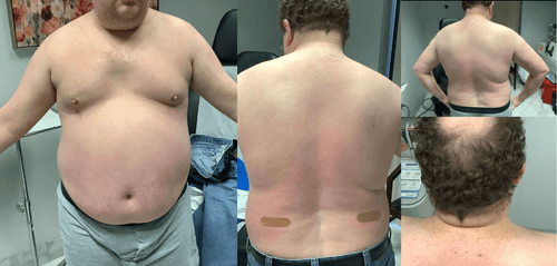 Treating Severe Recalcitrant Psoriasis