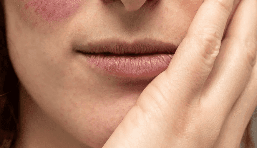 Is Oxymetazoline Effective for Persistent Facial Erythema of Rosacea?