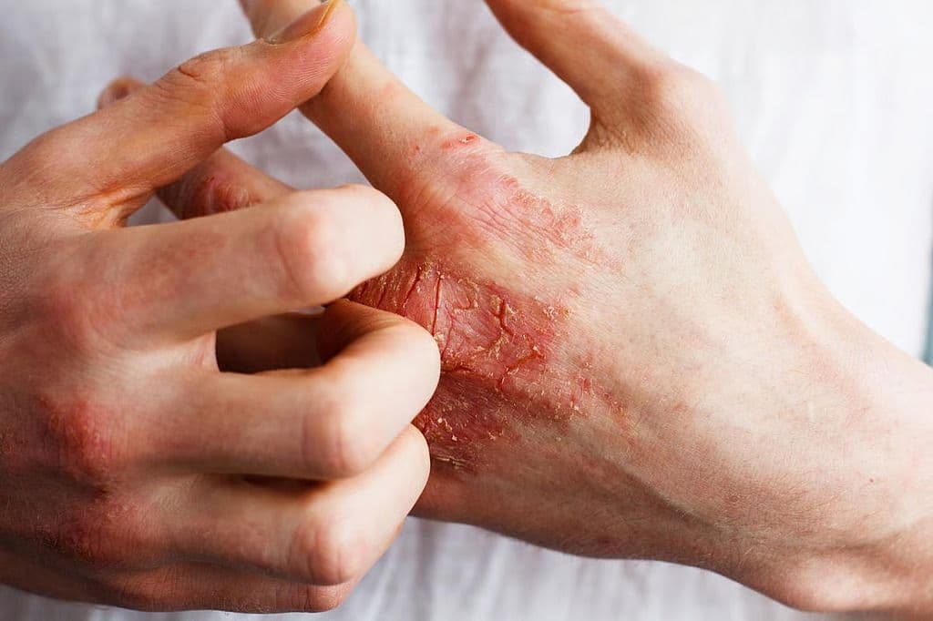 Atopic Dermatitis Flares and Quality of Life